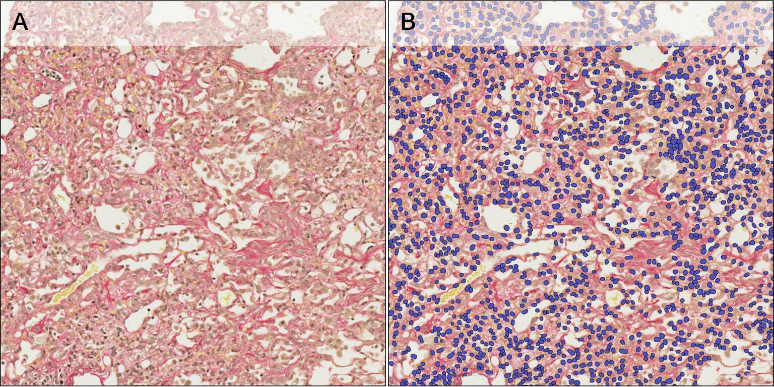 The Role of Pre-Clinical Bleomycin Models in IPF Drug Development ...